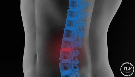 Conus Medullaris And Cauda Equina Syndrome Malpractice Lawyers