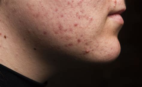 Understanding Dysplastic Nevi Identification Treatment And