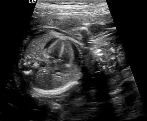Fetal Pericardial Effusion Treatment