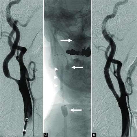 A Preoperative Fluid Attenuated Inversion Recovery Mri Showing Download Scientific Diagram