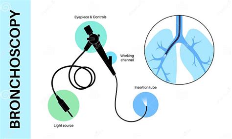 Bronchoscopy Procedure Concept Stock Vector Illustration Of Pneumothorax Biopsy 280635564
