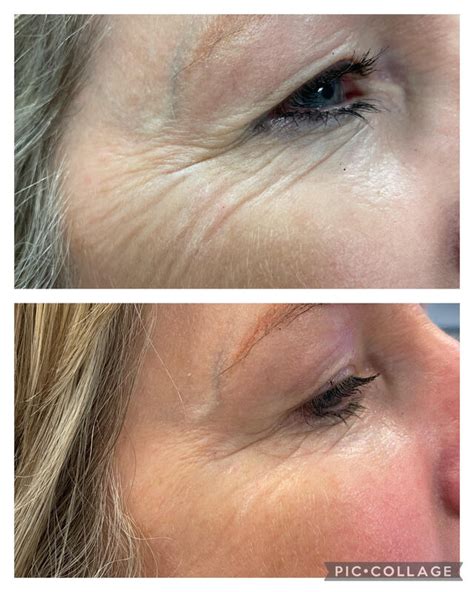 Botulinum Toxin Botox