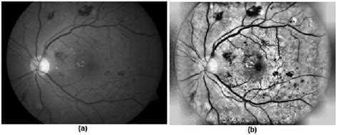 Fundus Image A Before And B After Applying Clahe [18] Download