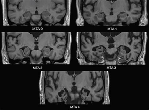 Brain Imaging In Differential Diagnosis Of Dementia Practical Neurology