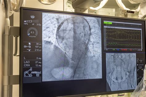 Istanbul Turkey February 29 2024 X Ray For Valvular Replacement With