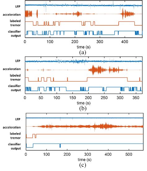 examples of tremor detection on three sample lfp recordings the