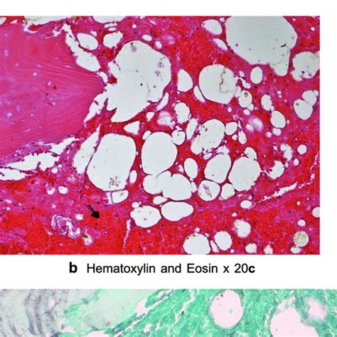 Ct Guided Biopsy Of The Left Tibia Download Scientific Diagram