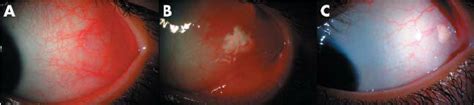 Active Diffuse Anterior Scleritis In The Temporal Quadrant Of The Left Download Scientific