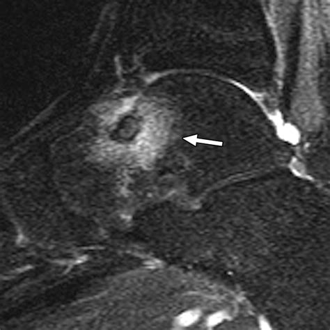 Pediatric Bone Imaging Diagnostic Imaging Of Osteoid Osteoma Ajr