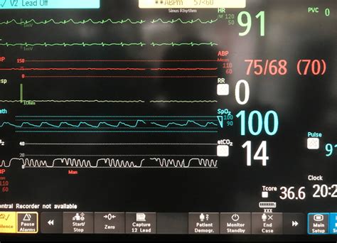 Ecmo But No Pulse Intensive