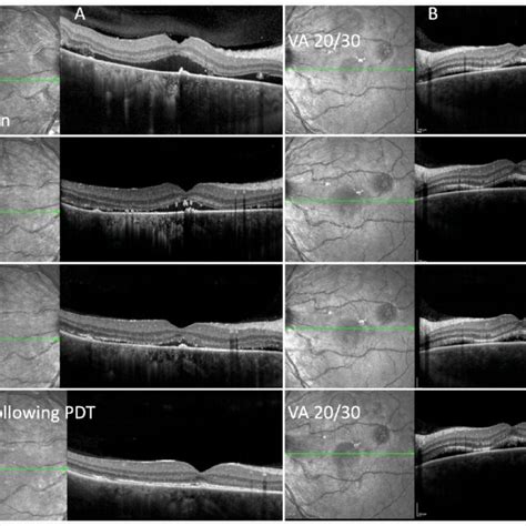 Macular OCT Showing Response To Photodynamic Therapy In The Right Eye Download Scientific