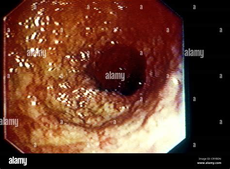 Rettocolite Ulcerosa Endoscopia Immagini E Fotografie Stock Ad Alta