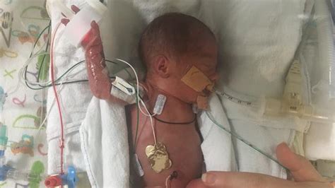 Jane Allsop Underbelly Chopper Twins Miracle Herald Sun