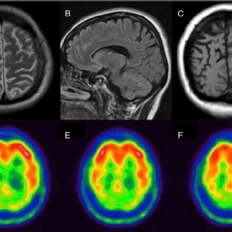 Normal Dat Scan A For Comparison Dat Scan Of A Patient With Dlb Download Scientific