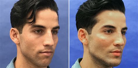 Models Before And After Surgery