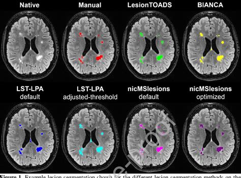 Figure 1 From Comparing Lesion Segmentation Methods In Multiple