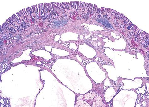 Epithelial Polyps And Neoplasms Of The Stomach Clinical Tree