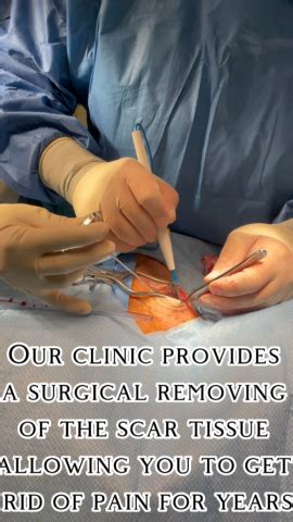 TRIGGER POINT EXCISION NEW TREATMENT