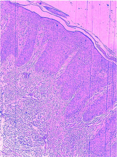 Chronic Eczema Histologic Features Discreet Spongiosis With