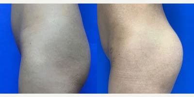 Butt Augmentation Before And After Pictures Realself
