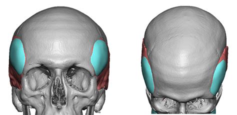 The Design Of The Forehead Widening Temporal Implant Explore Plastic Surgery
