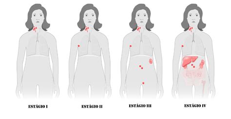 Recomeçar CÂncer Como Funciona O Protocolo Abvd Para O Linfoma De Hodgkin