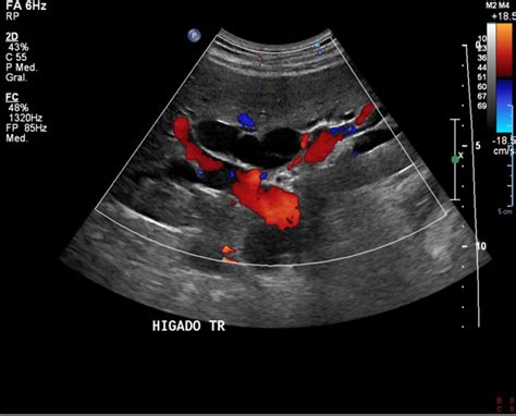 Colangiocarcinoma — Asesoría Y Gestion Radiológica