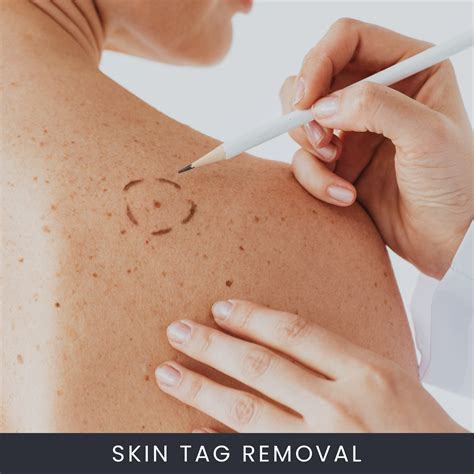Skin Tag Removal Skin Tag Removal Beauty Travels 24
