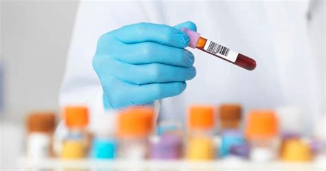 Xét Nghiệm Máu Hdl Cholesterol Là Gì