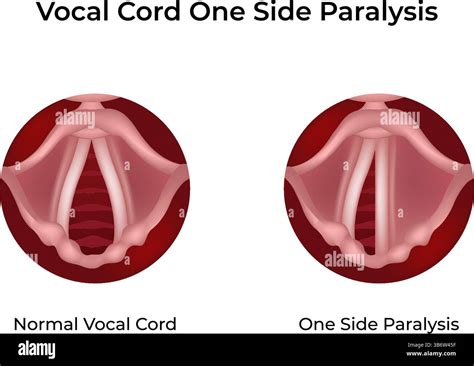 Vocal Cord Paralysis One Side Design Vector Illustration Stock Vector Image And Art Alamy
