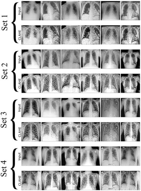 Four Transformer Based Deep Learning Classifiers Embedded With An Attention U Net Based Lung