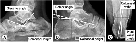 Calcaneum Fractures New