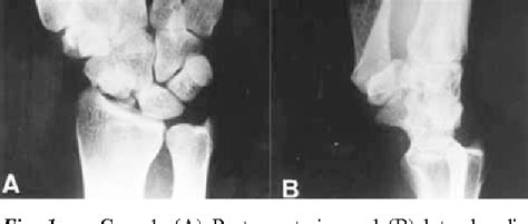 Figure 1 From Concurrent Scaphoid Fracture With Scapholunate Ligament Rupture Semantic Scholar