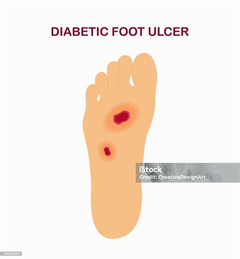Diabetic Foot Ulcers Sole Of Foot With Skin Sores And Ulcers Stock