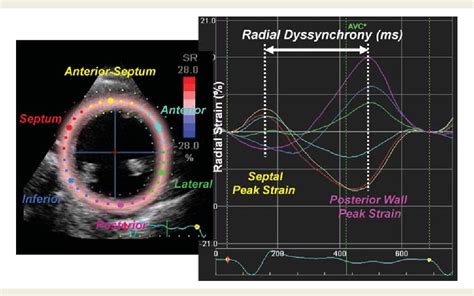 Intraventricular Conduction Defect Semantic Scholar