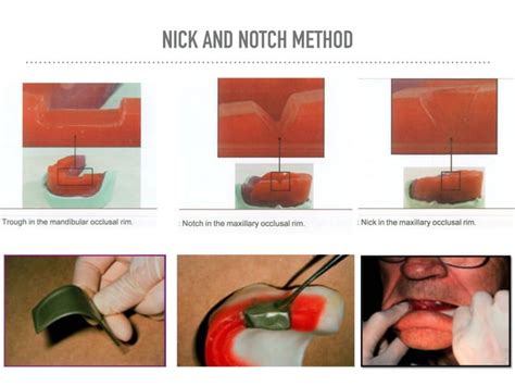 Centric Relation Seminar Pdf Dental Health Diseases And Conditions
