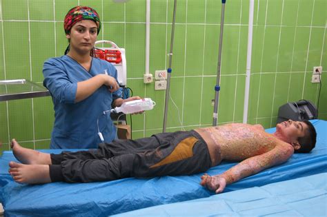 Turkish Forces Allegedly Burn Kurdish Boy With White Phosphorus
