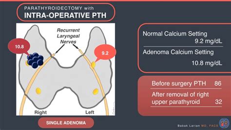 Intraoperative Parathyroid Hormone PTH Testing Dr Larian