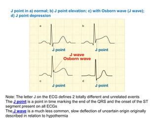 Osborn Wave J Wave In Ecg And Its Interpretation Pptx