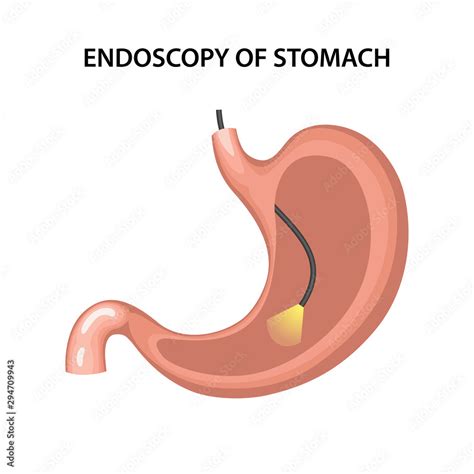 Endoscopy Diagnostic Of Human Stomach Human Stomach With Endoscope