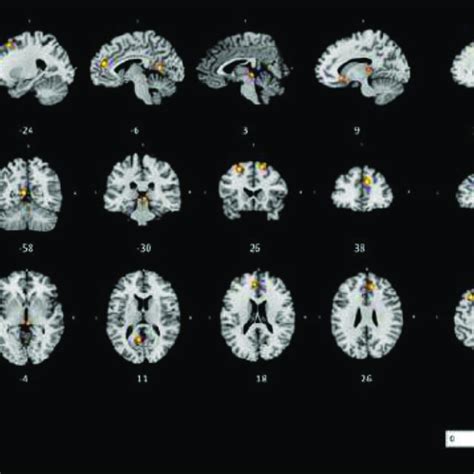 Ale Map Investigating Differences In Functional Mri Functional