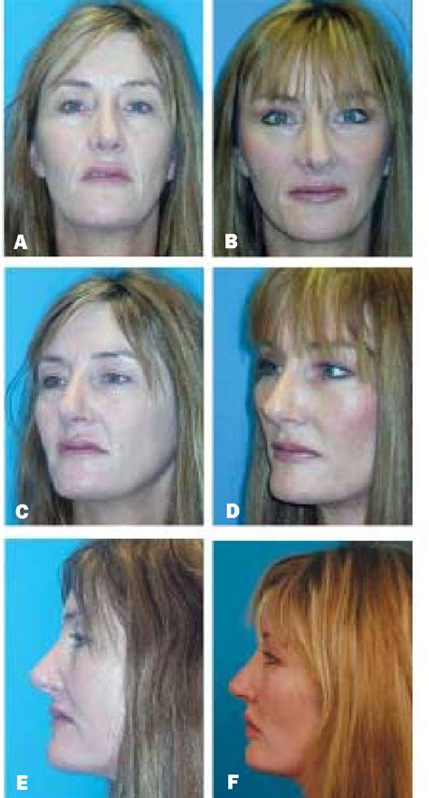Figure 6 From Endoscopic Temporal Incision Only Midface Lift Is