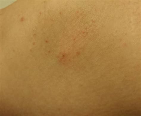 ダニに刺されたときの症状や特徴！あせもや蚊との違いは？ 日常の小石からハッピーまで