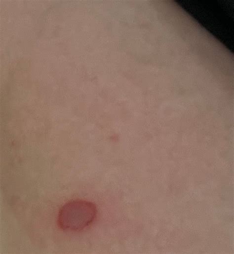 피부에 물린 듯한 상처 지식in