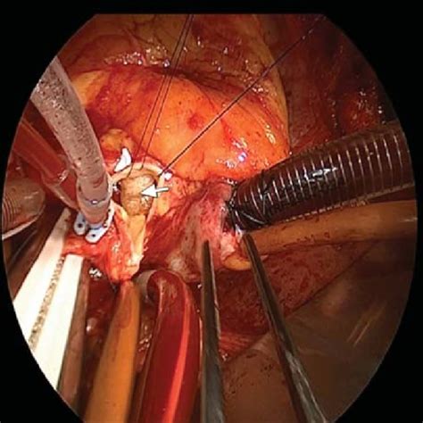 Intraoperative Photograph Shows A Soft Friable Mass Arrow Arising