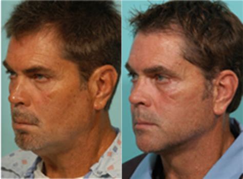 Endoscopic Endotine Forehead Lift At Travis Poteete Blog