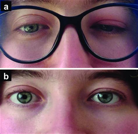 A Year Old Female Patient Presented With Non Globe Involved Apparent Download Scientific