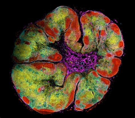 Spatial Multi Omics For Cancer Systems Biology