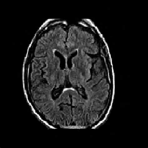 Figure 2 From Focal Lesion In Splenium Of Corpus Callosum On Flair Mri