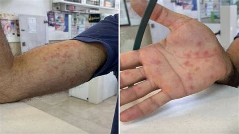 ابتلای یک خانواده به آبله میمونی در بابل صحت دارد؟